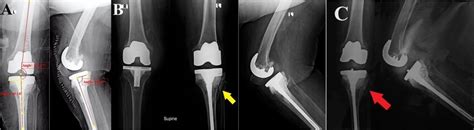 Postoperative And Follow Up Radiographs A Immediate Ap And Lateral