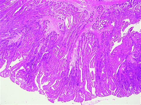 Scanner View Photomicrograph Of The Jejunal Polyp H And E Shows