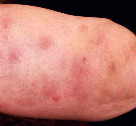 How Serious Is The Inflammatory Condition Known As Sarcoidosis