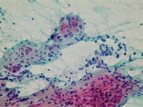Multinodular Goitre Eurocytology
