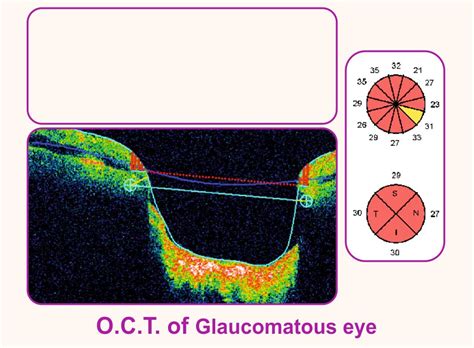 Glaucoma