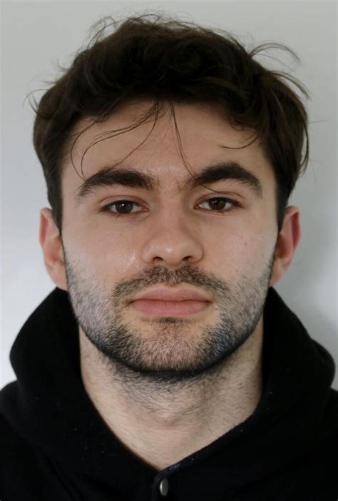 Is This Midline Discrepancy And Eye Asymmetry Still Fixable At 24 Rorthotropics