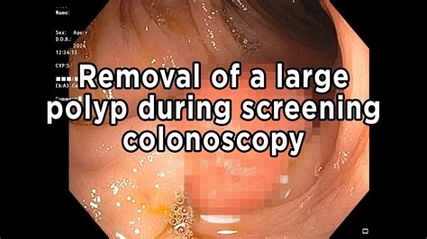 Removal Of A Large Polyp Found During A Screening Colonoscopy These Have No Symptoms Youtube
