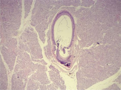 Warfarin Induced Calciphylaxis A Case Report And Review Of Literature Pmc