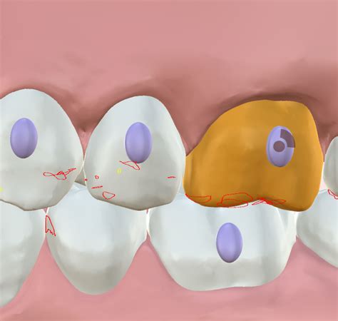 Clarifying Common Patient Queries About Attachments During Clear
