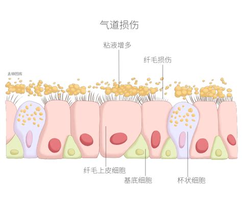 气道损伤（标注版） 医学插画
