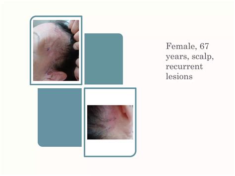 Dermoscopy Bcc M Bosseila 2018 Ppt