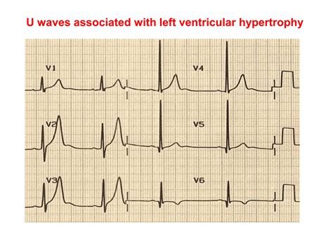 U Wave In Ecg And Its Abnormalities In Ecg Pptx