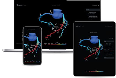 Heartflow Ffrct Analysis Heartflow