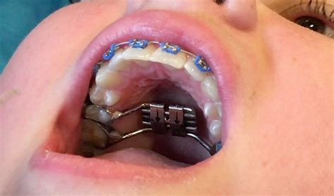 Removable Palatal Expander