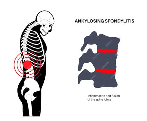 Premium Vector Ankylosing Spondylitis Arthritis That Causes