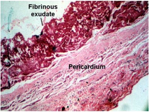 Fibrinous Exudate Definition And Examples Biology Online Dictionary