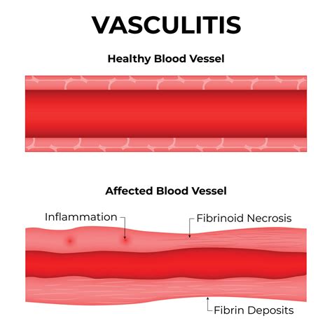 Vasculitis Science Design Illustration Diagram 45756082 Vector Art At Vecteezy
