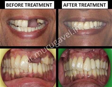 Multiple Teeth Replacement With Basal Implants