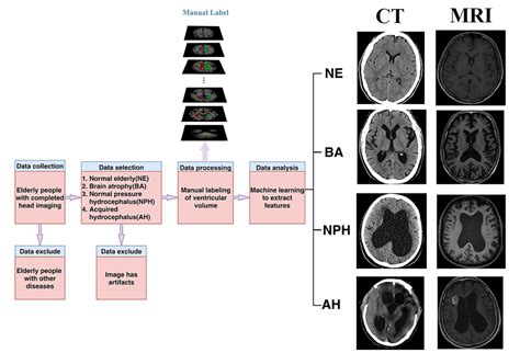 Figure 1 From Systematic And Comprehensive Automated Ventricle Segmentation On Ventricle Images