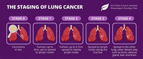 Stage 2 Of Lung Cancer