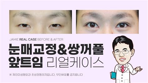 남자 쌍꺼풀수술 전후 후기 영상 앞트임 눈매교정 Youtube
