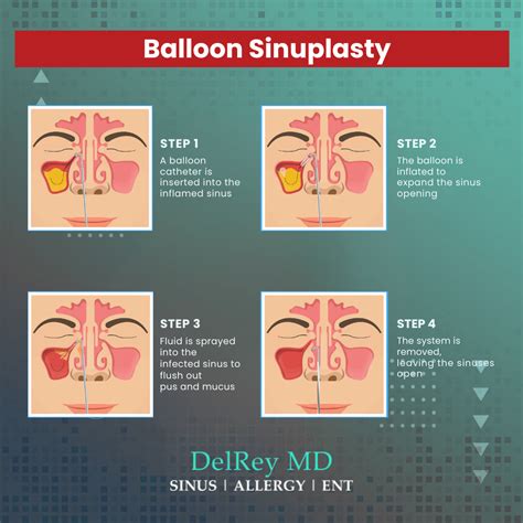 Stop Sinusitis Marina Del Rey Sinusitis Treatment Los Angeles