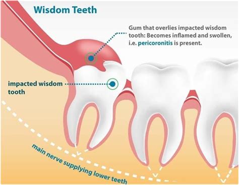 Pericoronitis World Class Dental Clinic Pune