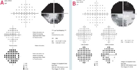 Visual Field Testing A Tool For All Glaucoma Stages