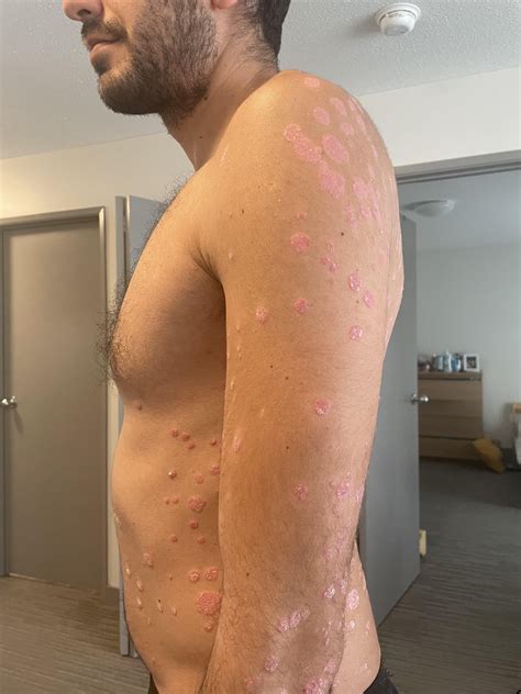 I Started Methotrexate Yesterday R Psoriasis