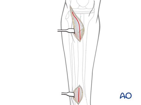 Mio Anterolateral Approach To The Proximal Tibia