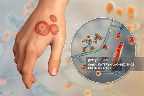 Ringworm Illustration High Res Vector Graphic Getty Images