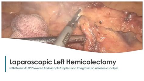 Laparoscopic Left Hemicolectomy Youtube