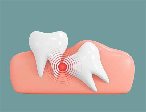 What Is An Impacted Wisdom Tooth Crystalline Dental