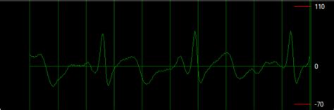 Result Of Filtering Of The Heartbeat Signal Using Butterworth Filter F