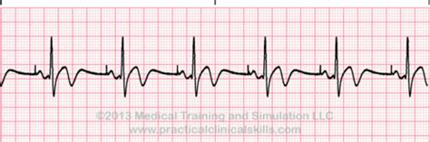 Pacemaker Flashcards Quizlet