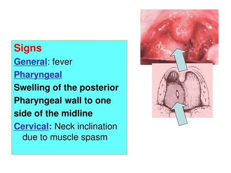 PPT Infection Of Pharyngeal Spaces PowerPoint Presentation Free Download ID 4100454