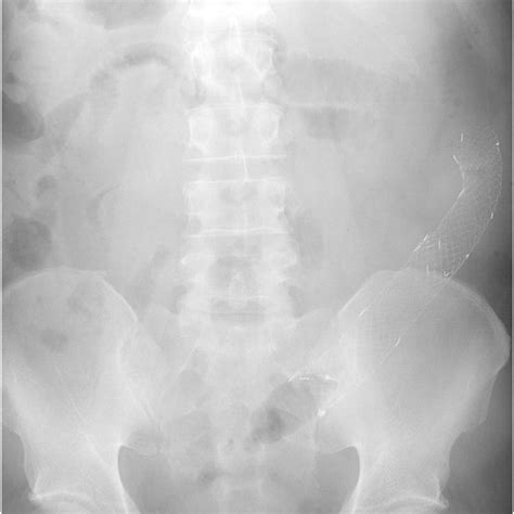 Sems Was Additionally Inserted To The Area Of Stenosis Download