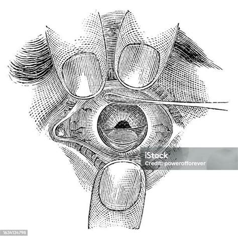 Medical Illustration Of Intracapsular Cataract Extraction Surgery Being Performed On A Human Eye