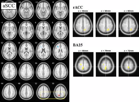 Anterior Subcallosal Cingulate Ascc Rostral Anterior Cingulate Download Scientific Diagram