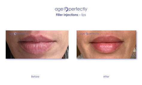 Treatments Photo Gallery Before And After Photos At Age Perfectly