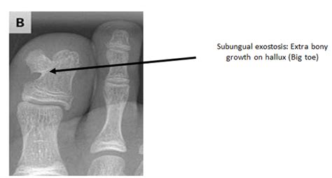 Management Of Nail Problems — Chelsea And Westminster Hospital Nhs