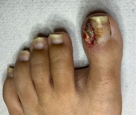 Phenolization Antonucci Dermatology Bologna