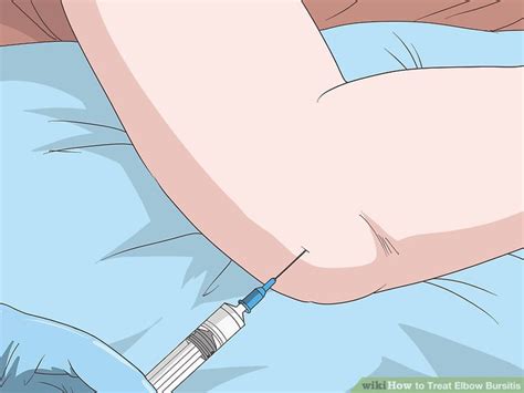 3 Ways To Treat Elbow Bursitis Wikihow Health