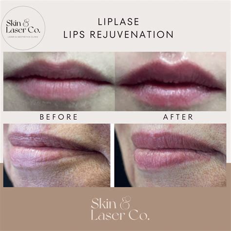 Liplase™ Lip Rejuvenation Skin Laser Co