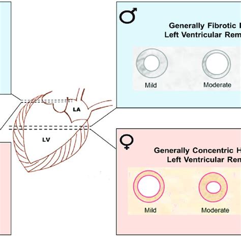 Sex Dependent Differences In LVH Phenotypes In Men And Women Summary Download Scientific