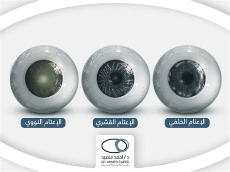 أنواع المياه البيضاء في العين وطرق علاجها د أحمد سعيد