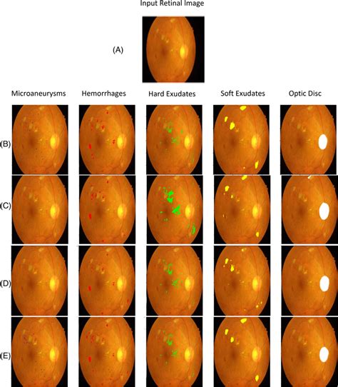 Comparison The Segmentation Results Of Proposed MRTSegNet With