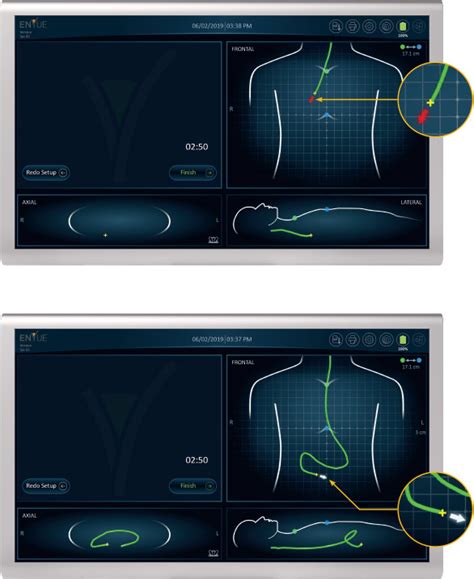Envue System Envue Medical