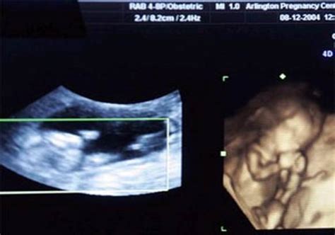 Doctors Get Yrs Ri For Carrying Out Sex Determination Test India News India Tv