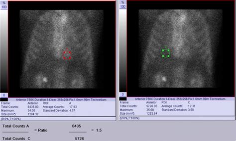 Interpreting Technetium 99m Pyrophosphate Cardiac Scans To Diagnose