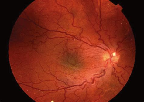 Vitreous Opacity Posterior Vitreous Detachment Symptoms Causes