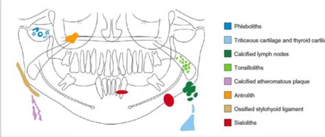 Panoramic Imaging Soft Tissue And Air Soft Tissue Calcification