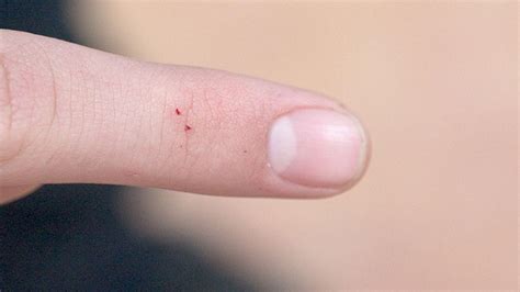 Black Widow Bites Identifying Bites First Aid Outlook And More