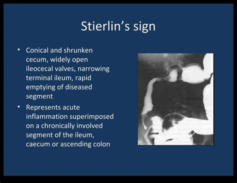 Tb And Typhoid Lesions Of Small Intestine Pptx